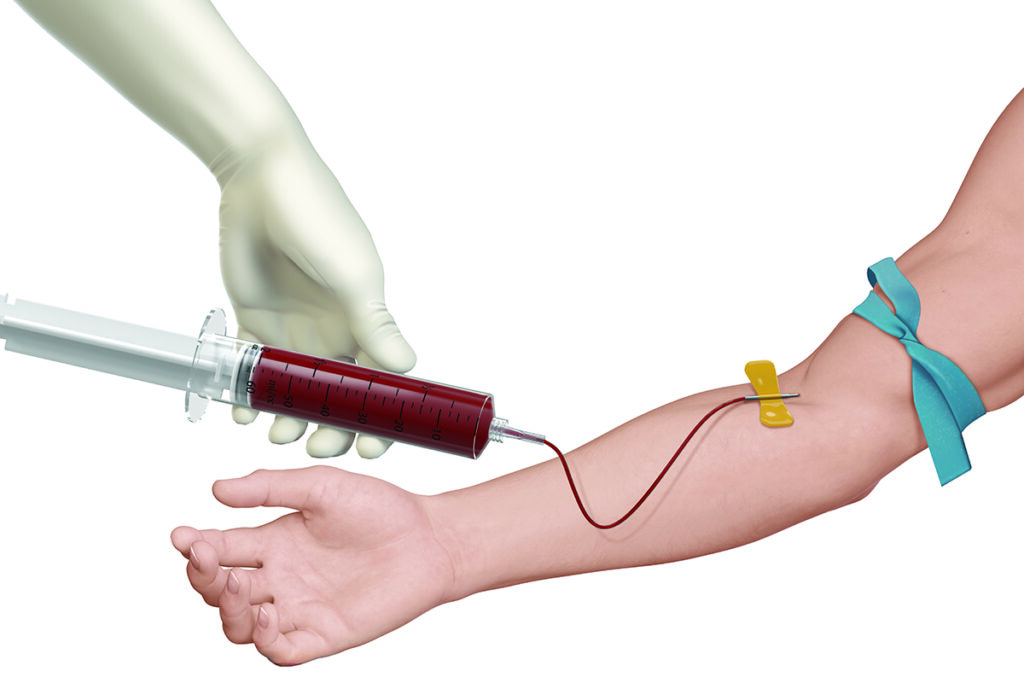 ACP Max™ - ACP Thérapie | Arthrex